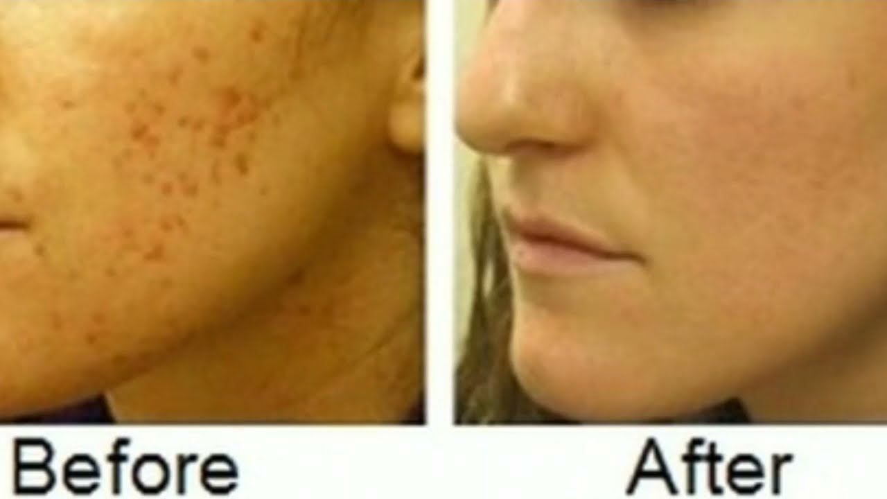 Acne Scar Treatment: Causes, Types, and Effective Solutions
